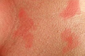 Neurodermitis | HC Marbella International Hospital