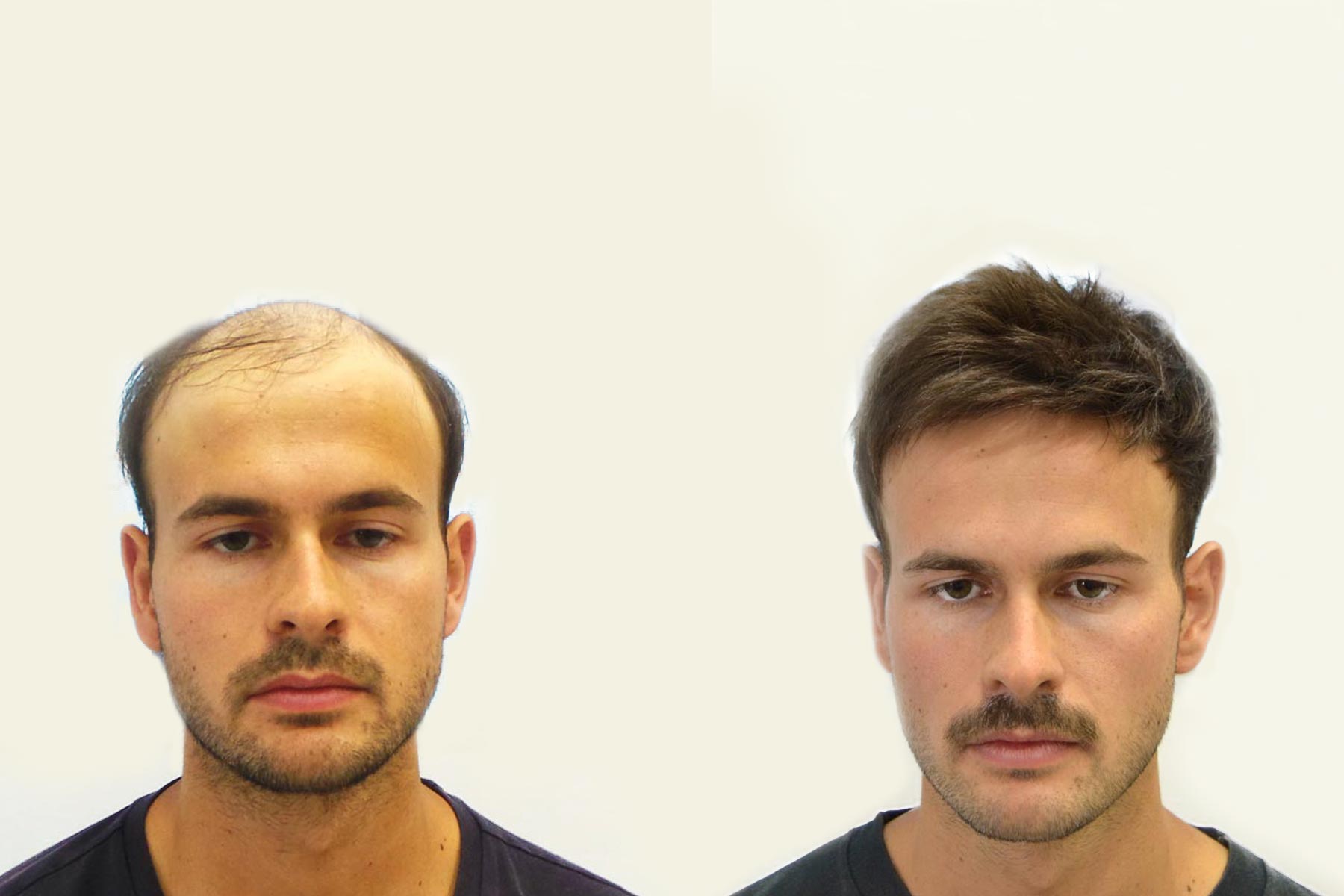 Hair prostheses - HC Marbella | HC Marbella International Hospital