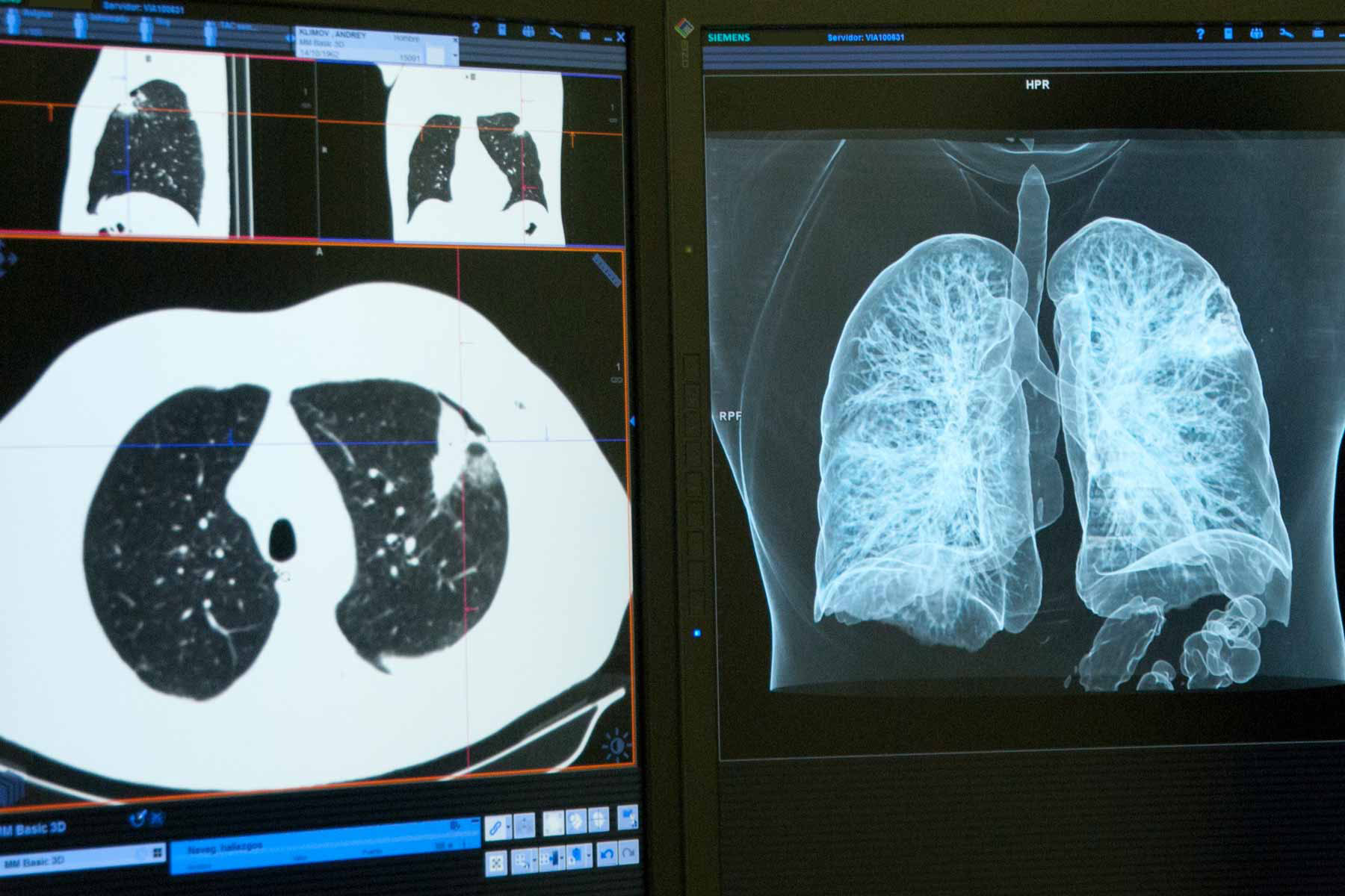 Diagnóstico de Cáncer de pulmón - HC Marbella | HC Marbella ...